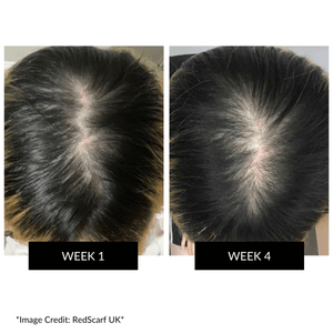 LED Hair Growth Helmet | Red Light Therapy for Hair Loss | CurrentBody HK